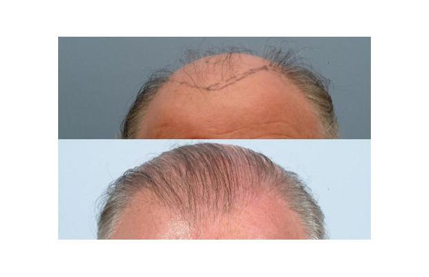 Bald scalp hair transplant before and after photos | Hair Transplant ...