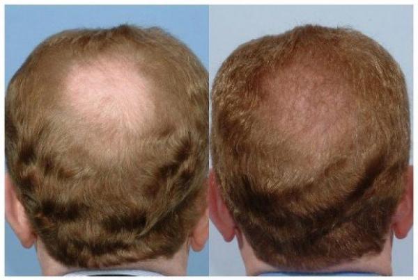 What Causes Hair Loss In Men