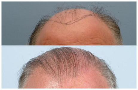 Bald scalp hair transplant before and after photos