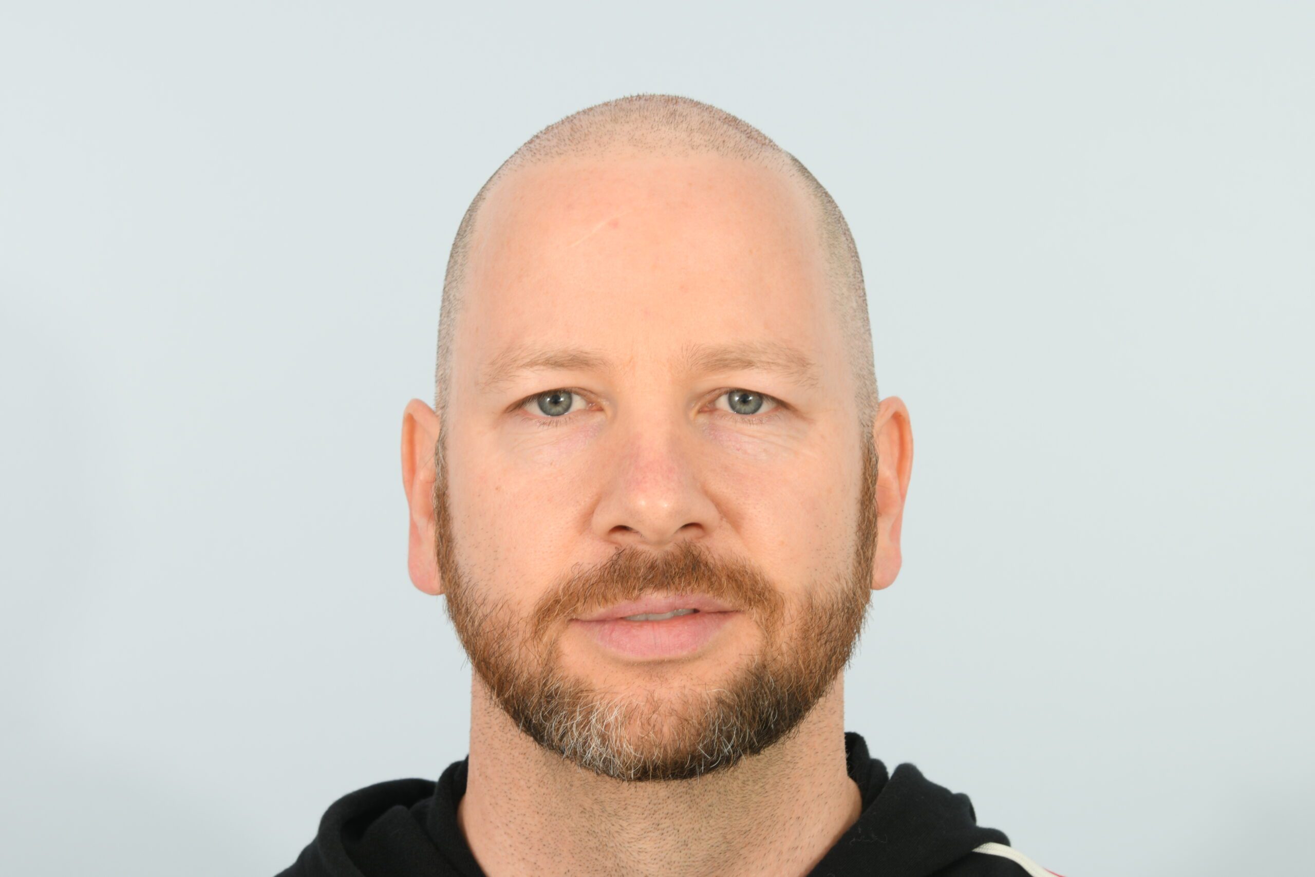 Mark Fennell Hair Transplant - Hair Transplant Clinic Ireland